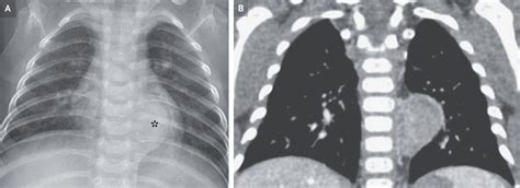 Incidental Neuroblastoma Nejm