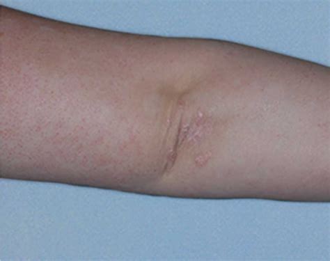 Plaque Psoriasis Before And After Photos Otezla Apremilast Results