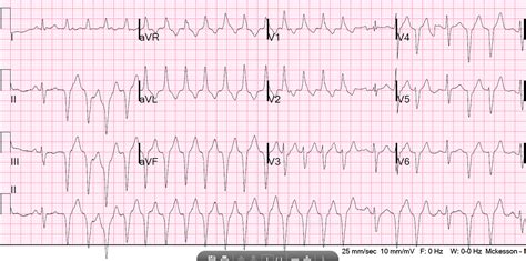 Dr Smith S ECG Blog Incessant Regular Wide Complex Tachycardia
