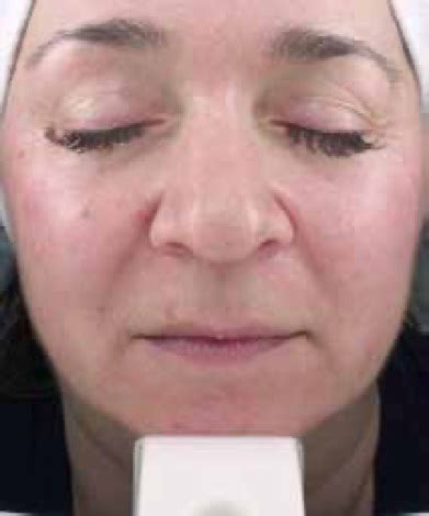 Thermolyse visage La technique de dépilation définitive pour un