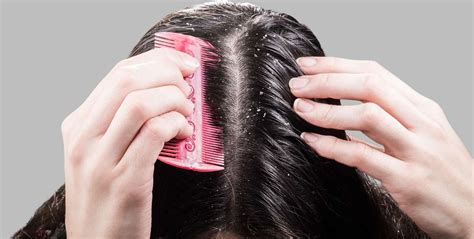 Dermatite seborreica o que é causas sintomas e tratamento