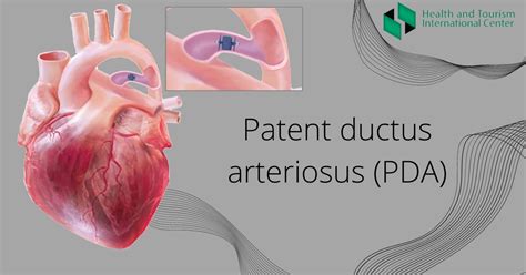 Patent Ductus Arteriosus HTI CENTERS Medical Tourism Center