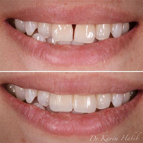 Composite Veneers Sydney Dental Bonding Sydney Dentist Ryde