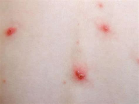 Skin Herpes Symptoms Description With Photos Causes Treatment And