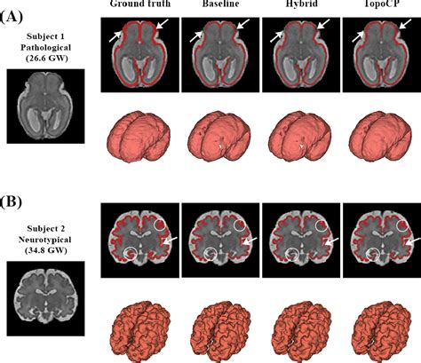 figure 1 from multi dimensional topological loss for cortical plate segmentation in fetal brain