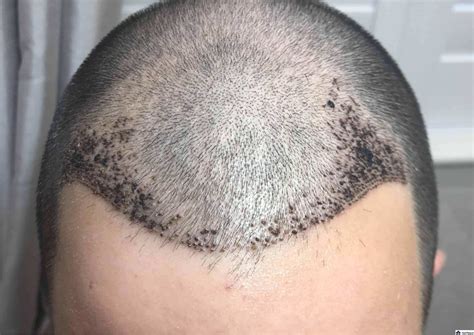 Hair Transplant After 7 Days Photos Results Aftercare