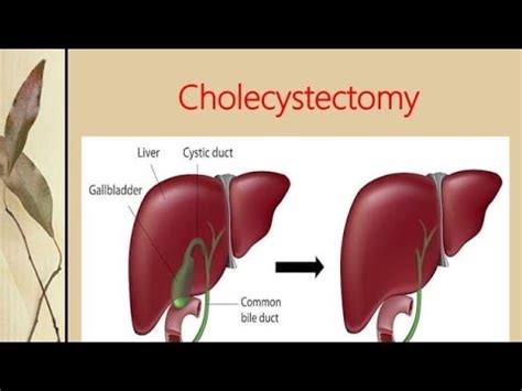 Cholecystitis Causes Sign And Symptoms Diagnosis Treatment