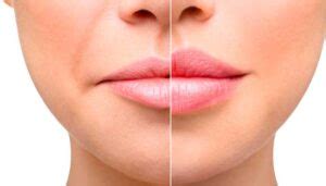 7 Consejos Para La Hidratación De Labios Con Ácido Hialurónico