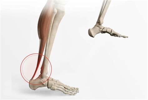 Symptômes et diagnostic de la tendinite du talon d Achille Dr Paillard