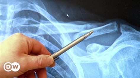 Reposo u operación como se trata una fractura de clavícula DW 30