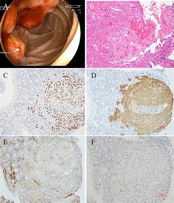 Frontiers Case Report Advanced Primary Squamous Cell Carcinoma In
