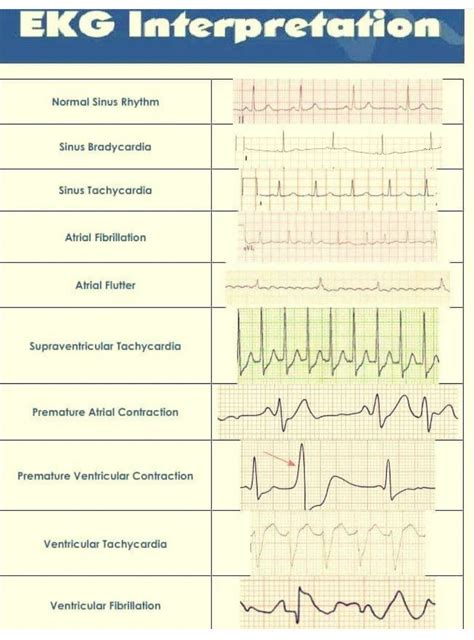 EKG Interpretation MEDizzy