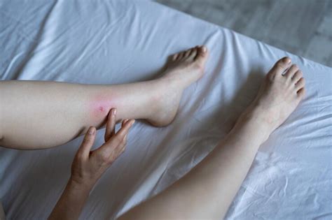 Qué hacer si te picó una araña violinista CHIC Magazine