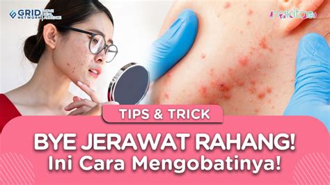 Patut Dicoba Ternyata Ini Cara Mengatasi Jerawat Di Rahang YouTube