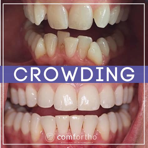 Invisalign Before And After Severe Crowding