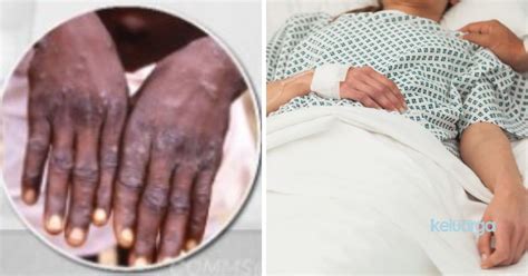 KKM Beri Amaran Penularan Wabak Monkeypox Dah Merebak Beberapa Buah