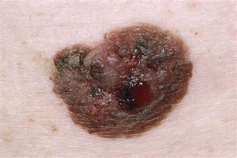 Nodular Melanoma On A Superficial Spreading Melanoma Stock Image