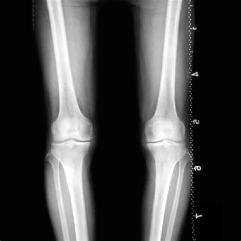 Preoperative Standing Anteroposterior Radiograph The Para Relationship