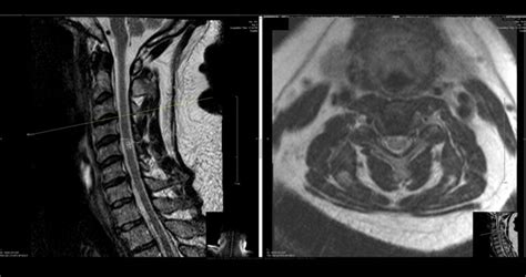 MRI Of Herniated Cervical Disc Dr Kevin Pauza The Discseel