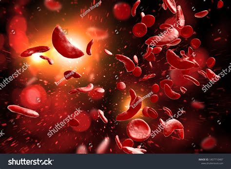 Sickle Cell Anemia Disease Scd Blood 库存插图 1807710487 Shutterstock