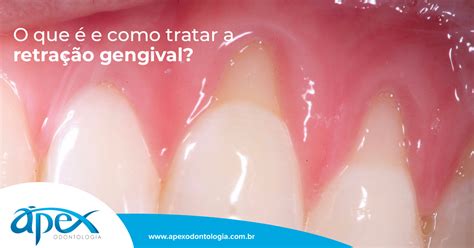 O que é e como tratar a retração gengival Ápex Odontologia