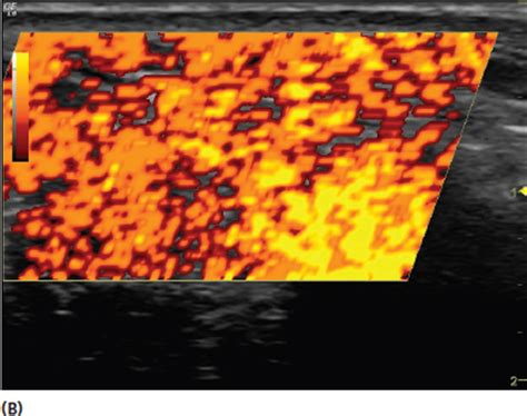 Doppler Imaging Radiology Key