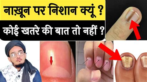 Nakhun Par Safed Nishan Ka Matlab Nakhun Par Kala Nishan Ka Matlab