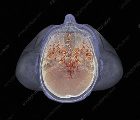 Human Head 3D CT Scan Stock Image C021 1930 Science Photo Library
