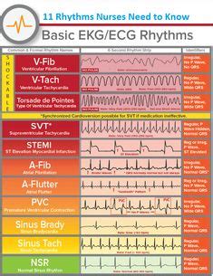 Basic ECG EKG Rhythms NCLEX Cheat Sheet Nurse Nursing School