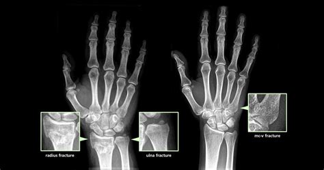 detecting fractures in the radius ulna and metacarpal bones on conventional radiographs ai