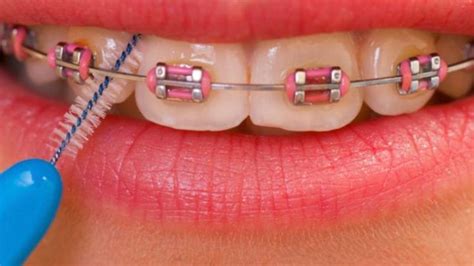 Pin En LIMPIEZA DENTAL