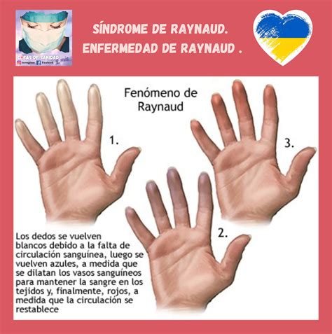 SÍNDROME DE RAYNAUD ENFERMEDAD DE RAYNAUD