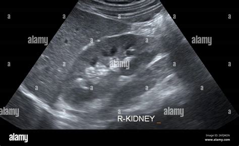 Riñón sano ultrasonido Fotografía de stock Alamy
