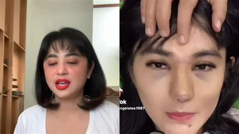 7 Potret Artis Ini Wajahnya Terlihat Bengkak Usai Operasi Bikin