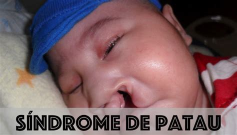 Síndrome de Patau O que é sintomas diagnóstico tratamento