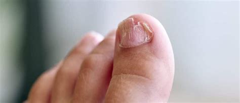 Dicas Para Evitar Fungos E Micoses Nas Unhas TendTudo Digital