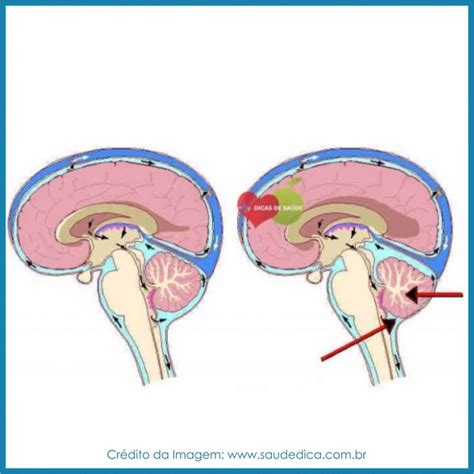 Diagnóstico da síndrome de Arnold Chiari