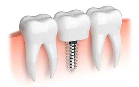 Guide Complet De L Implant Dentaire Comment Se Le Faire Poser