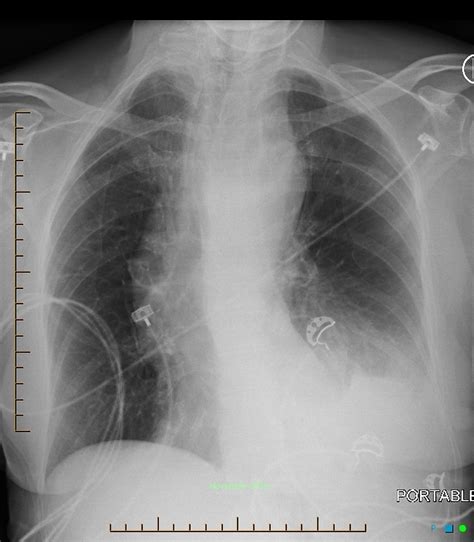 Aortic Dissection X Ray