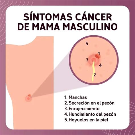 C Ncer De Mama En Hombres Una Enfermedad Neopl Sica Poco Frecuente