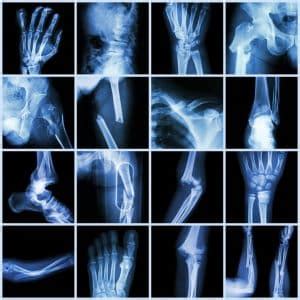 Xrays Of Broken Bones