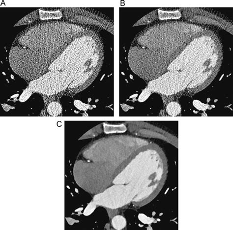iterative model reconstruction improved image quality of low tube voltage prospective ecg gated