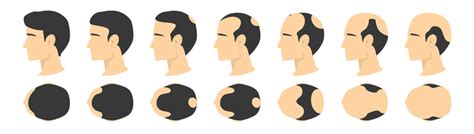 Comment identifier un début de calvitie en 2024 Elithair