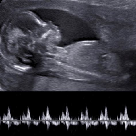 Weeks Pregnant Ultrasound Gender