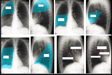 Cxr Diagram Quizlet
