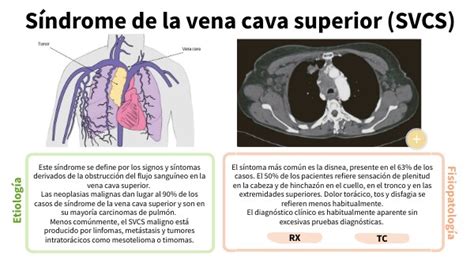 Teleterapia en Síndrome de compresión de la vena cava superior