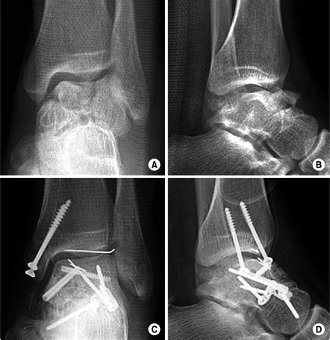 Talar Neck Avulsion Fracture
