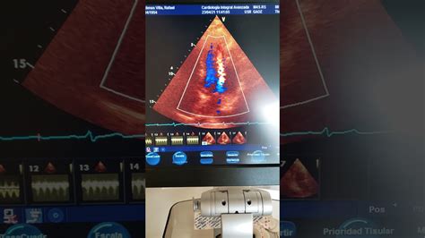 Ecocardiograma Doppler Color Youtube