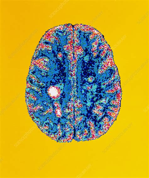 Col MRI Scan Of A Brain With Multiple Sclerosis Stock Image M210
