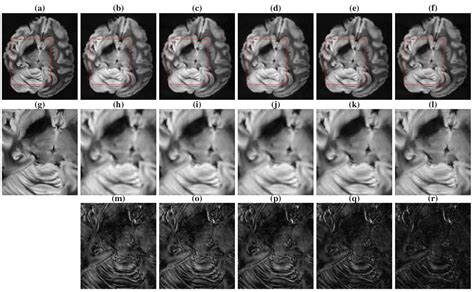 compressed sensing mr image reconstruction parietal